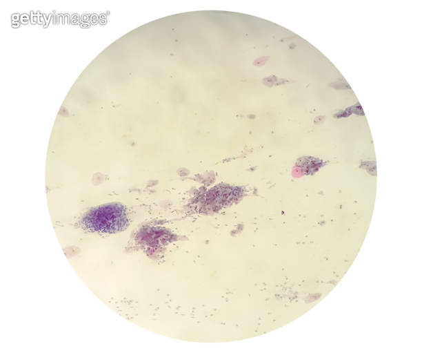 Microscopic view of Trichomonas vaginalis in pap smear with few acute ...