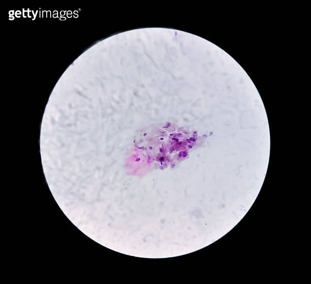 Microscopic view of Trichomonas vaginalis in pap smear with few acute ...