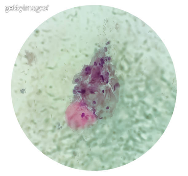 Microscopic view of Trichomonas vaginalis in pap smear with few acute ...