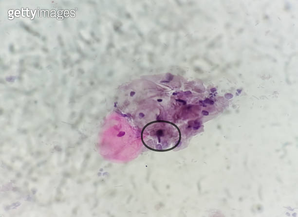 Microscopic view of Trichomonas vaginalis in pap smear with few acute ...