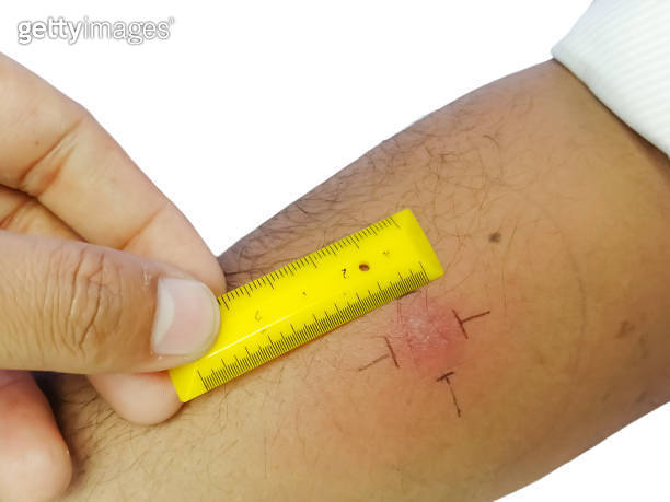 Mantoux vaccination, Closeup view photography of patient arm with red ...