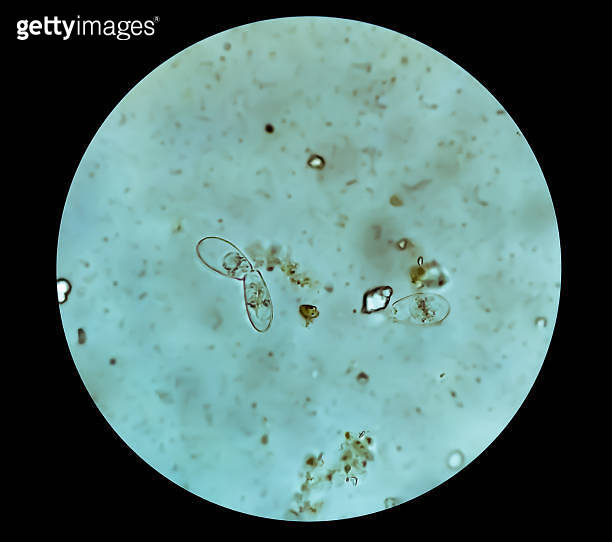 Schistosoma Haematobium Parasite ova in human urine specimen under ...