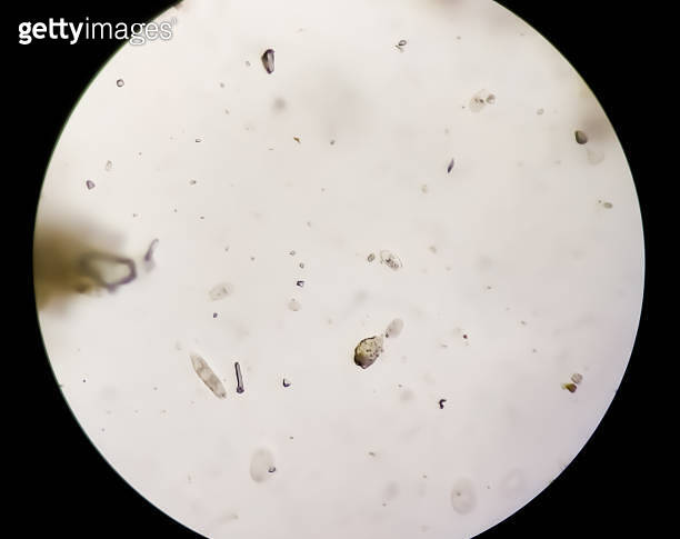 Schistosoma Haematobium Parasite ova in human urine specimen under ...