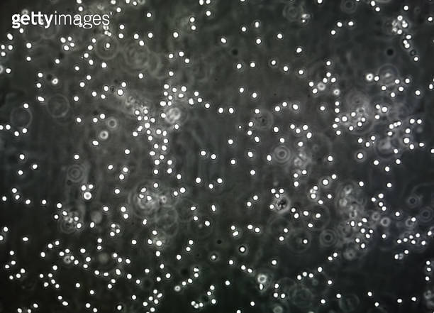 Microscopic image of urinalysis showing plenty Pus cells and RBC ...
