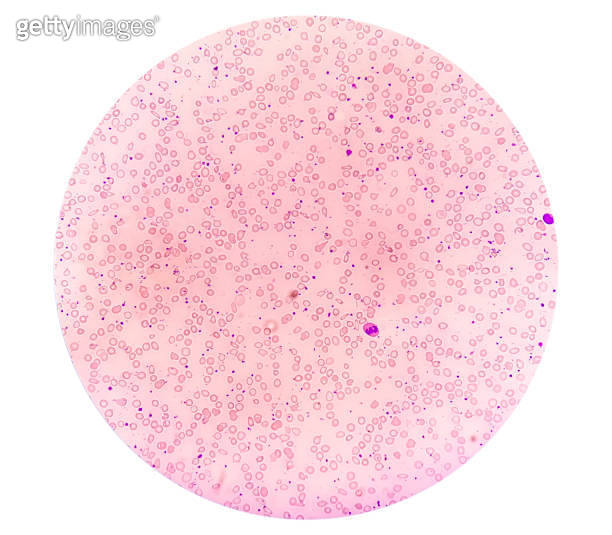 Blood Film: RBC: Hypochromic, anisocytosis with microcytes, target cell ...