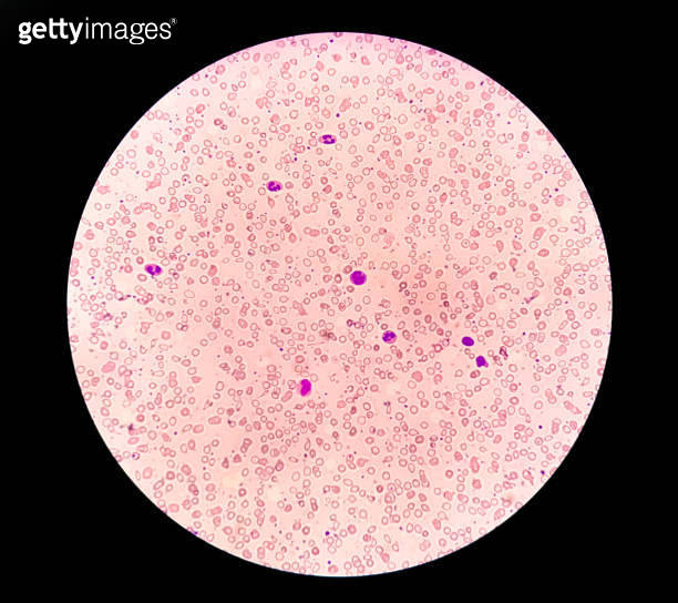 Blood Film: RBC: Hypochromic, anisocytosis with microcytes, target cell ...