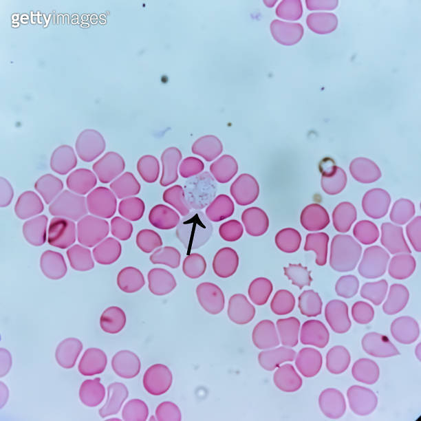 Plasmodium vivax in thin film under microscopy, Malaria disease. P ...