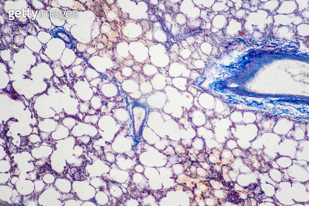 Human lung pathology under light microscope, The lungs is organs of the ...