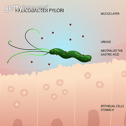 Helicobacter pylori on epithelial cells in human stomach illustration (1456986163) - 게티이미지뱅크