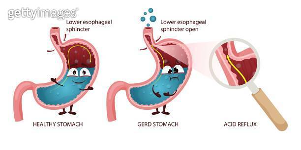 Cute healthy and GERD stomach cartoon characters with faces and ...