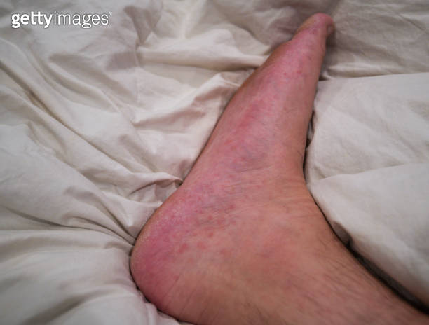 Syphilis rash. Reddish dots on bottom of foot. (1634957510) - 게티이미지뱅크