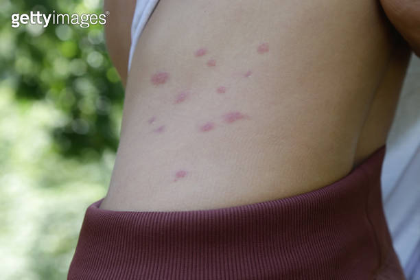 Red, swollen and itchy spots on skin caused by insect bites or allergy ...