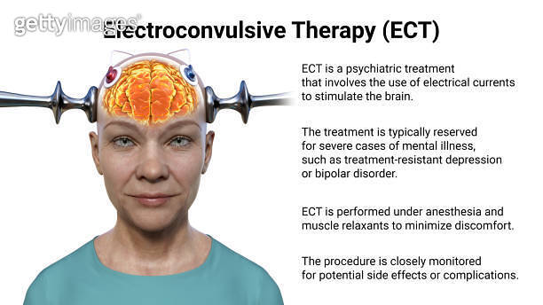 Electroconvulsive therapy, ECT, a treatment involving the use of ...