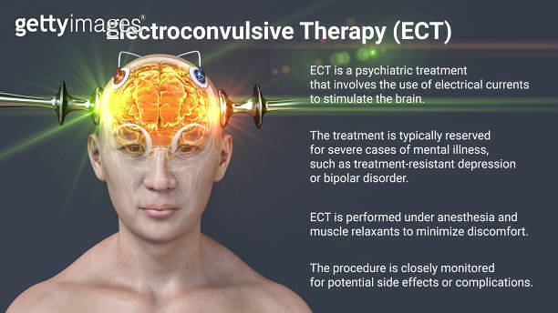 Electroconvulsive therapy, ECT, a treatment involving the use of ...