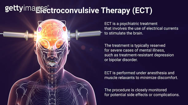 Electroconvulsive therapy, ECT, a treatment involving the use of ...