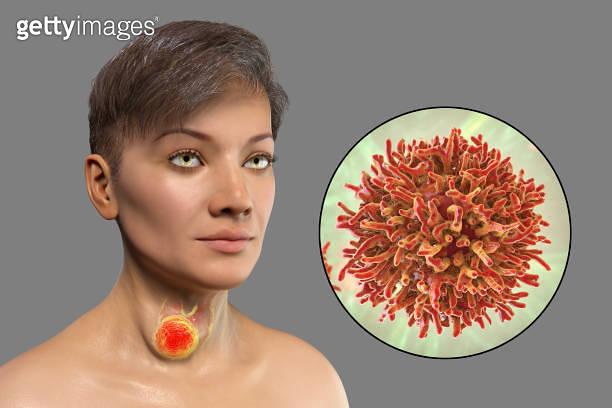 A 3D scientific illustration of a woman with thyroid cancer, and close ...