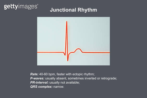 Electrocardiogram displaying a junctional rhythm, 3D illustration 이미지 ...