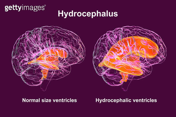 Enlarged ventricles of the child brain and normal ventricular system ...