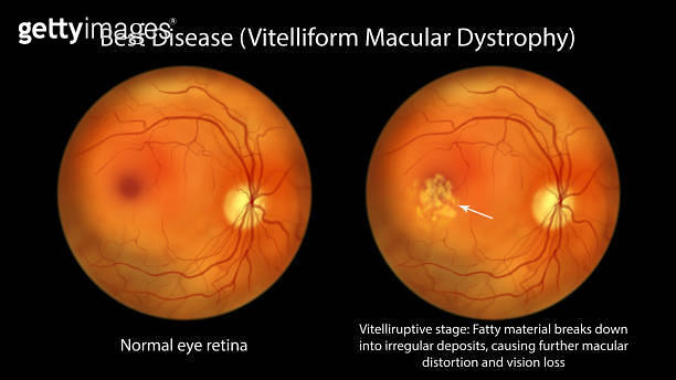Best disease, an illustration showing normal eye retina and Best ...