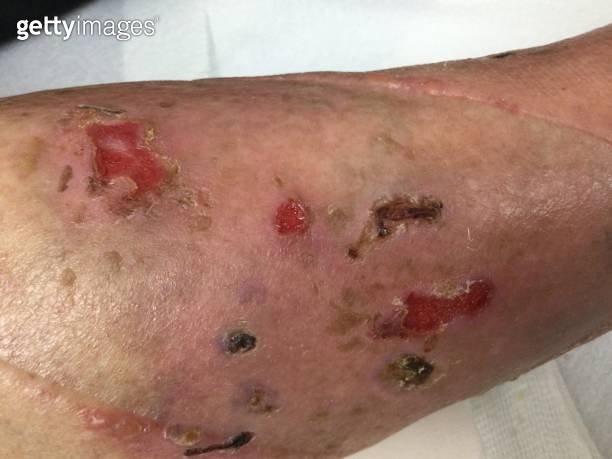 Multiple skin ulcerations and abrasions on human leg during wound care ...