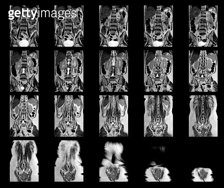 MRI OF THE THORACOLUMBAR SPINE a patient who has moderate to severe ...