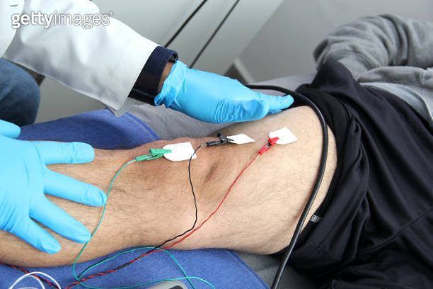 Electromyography EMG and Somatosensory Evoked Potential PEV of lower ...