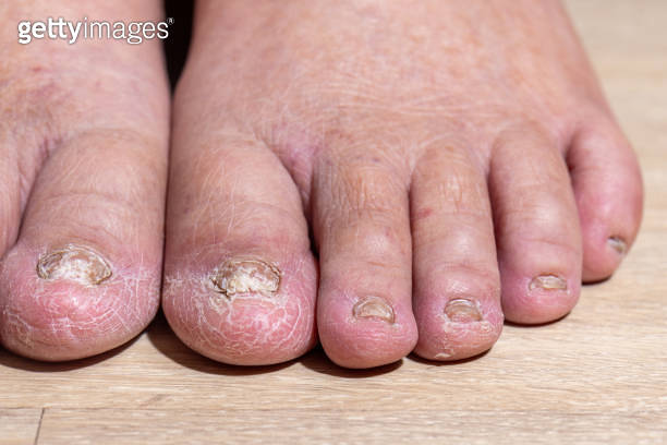 Cancer chemotherapy cause swelling of ankles (ankle oedema) , skin to ...