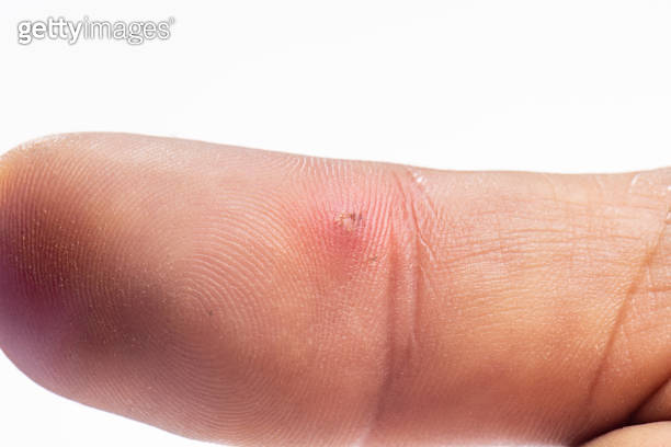 Finger with infection from wood splinter 이미지 (1518259034) - 게티이미지뱅크