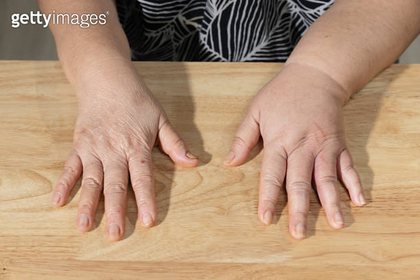 Cancer chemotherapy cause swelling hand , skin to become dry, dark or ...