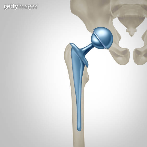 Hip Replacement Surgery 이미지 (1493208053) - 게티이미지뱅크