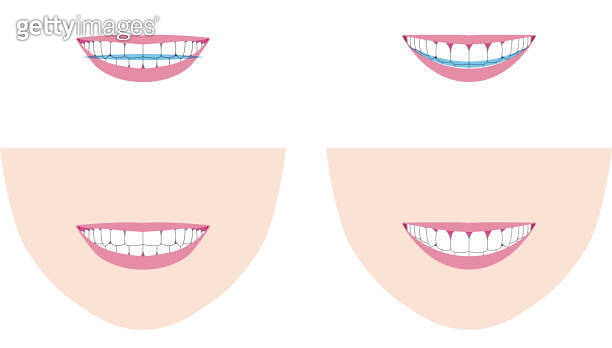 Vector illustration of how the row of teeth looks in a smile. Smile ...
