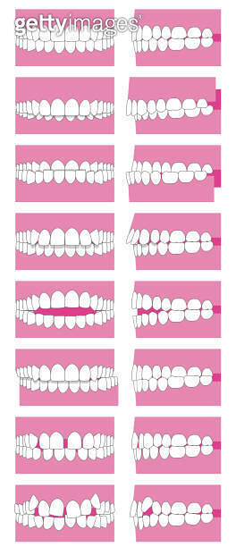 Types of tooth alignment and malocclusion. Front and side vector ...