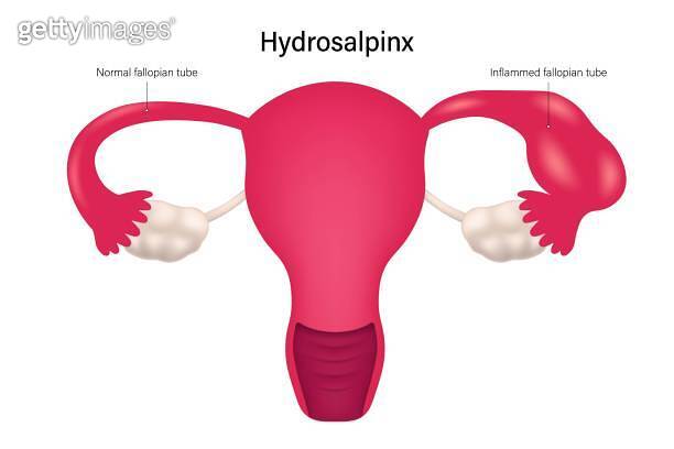 Hydrosalpinx vector. Block fallopian tube. Inflamed fallopian tube ...