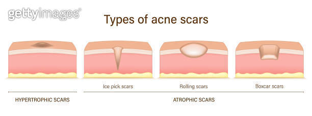 Types of acne scars. Facial skin problems. Hypertrophic scars and ...