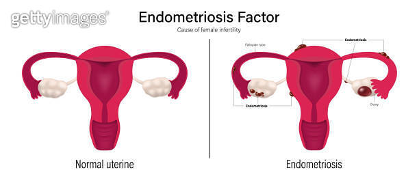 Female infertility vector. Comparison of normal uterus and ...