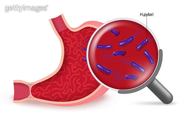 Stomach diseases vector. Helicobacter Pylori in the stomach. Bacterium ...