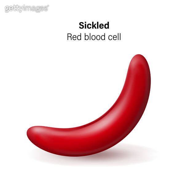 Sickle cell disease. Sickled red blood cells vector. 이미지 (2134325491 ...
