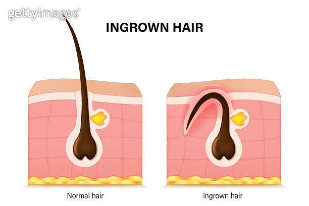 Normal and Ingrown hair. Structure of human hair follicle. Ingrown hair ...
