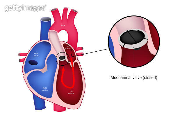 Aortic valve replacement with mechanical valve. Close up of open ...