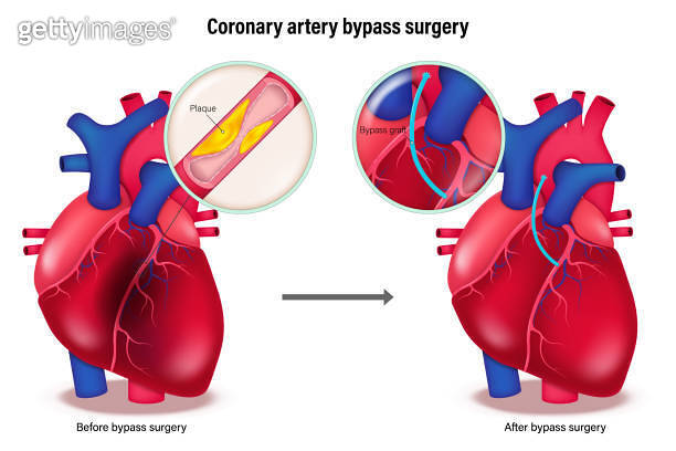 Coronary artery bypass surgery. Heart muscle damaged by blockage of the ...