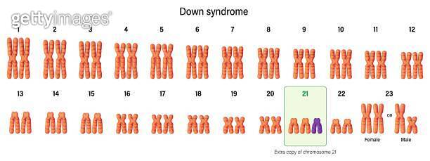 karyotype of Down syndrome. Autosomal abnormalities. Trisomy 21 ...