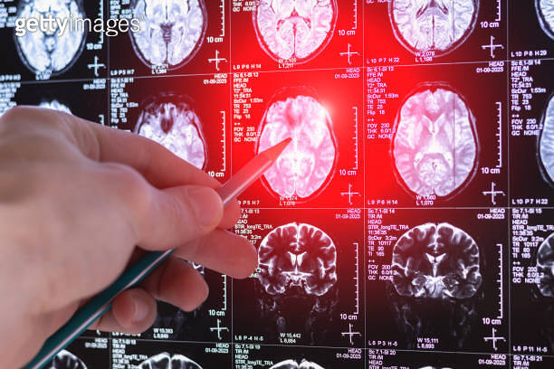 Doctor examining MRI, MRT, CT scan image of human brain. Medical ...
