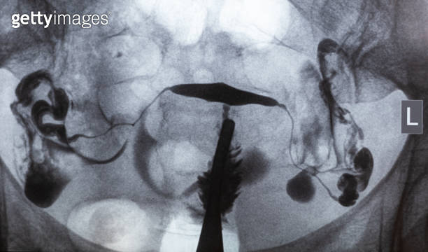 X-ray image of Hysterosalpingography (HSG). MRI with contrast agent ...