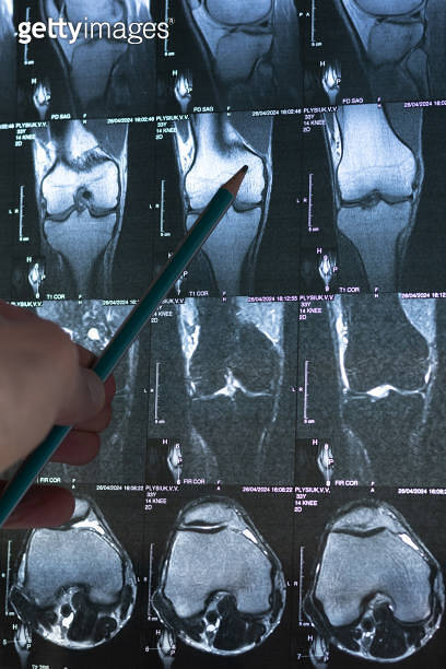 Doctor examining bone knee tumor. X-ray and MRI, MRT, CT with marked ...