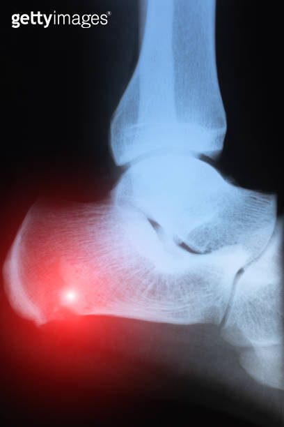 Vertical X-ray scan of Calcaneus or heel bone destruction. Bone of the ...