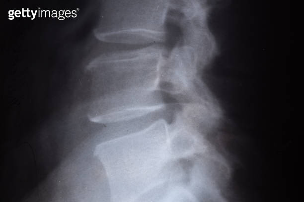 X-ray and MRI, MRT, CT with the human spine with defects in bones and ...
