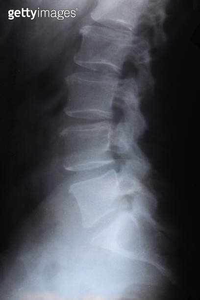 Vertical X-ray and MRI, MRT, CT with the human spine with defects in ...