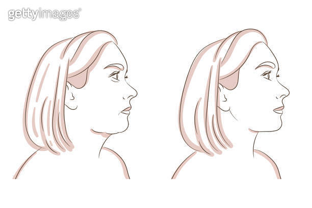 Reduce double chin, jawline plastic and cosmetology. Get rid of face ...