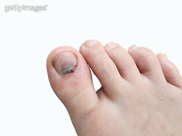 Subungual Hematoma is bleeding and bruising under the fingernails or ...