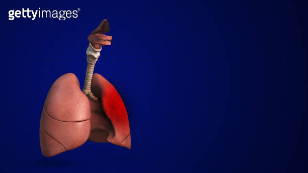 Human Lung Infection Respiratory Inflammation Disease (2153932800) 일러스트 ...